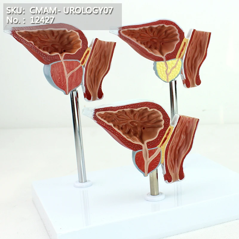 Aliexpress.com : Buy CMAM/12427 Normal and Diseased Prostate Gland ...