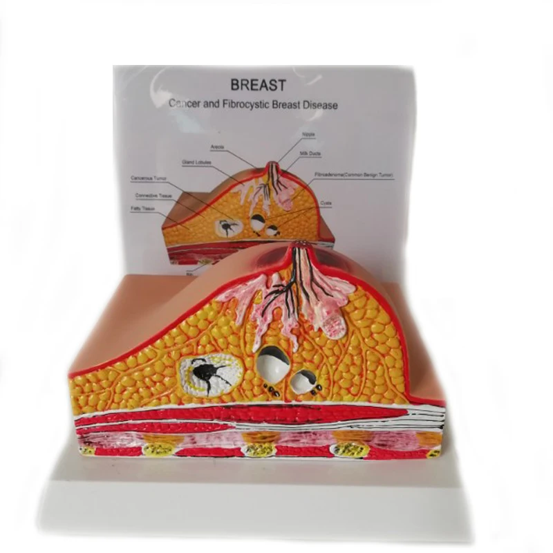 1:1 Median Section Of Human Female Breast Pathology Anatomy Model ...