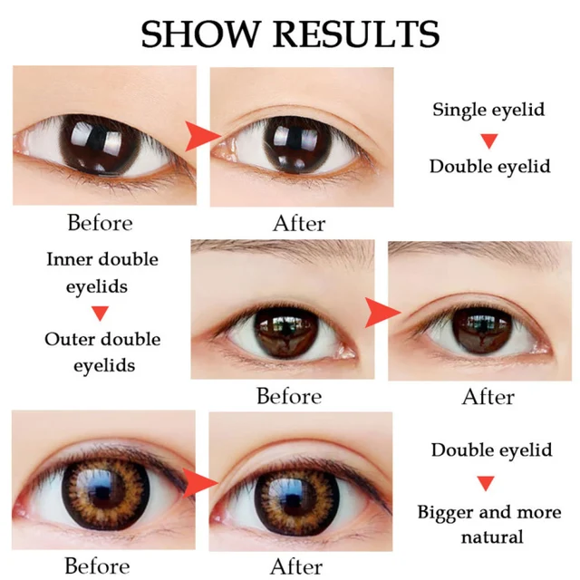 Single Eyelid Vs Double Eyelid