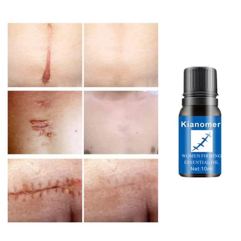 10ml Scars Removal Oil Nourishing Skin Lightening Pigment Acne Marks ...
