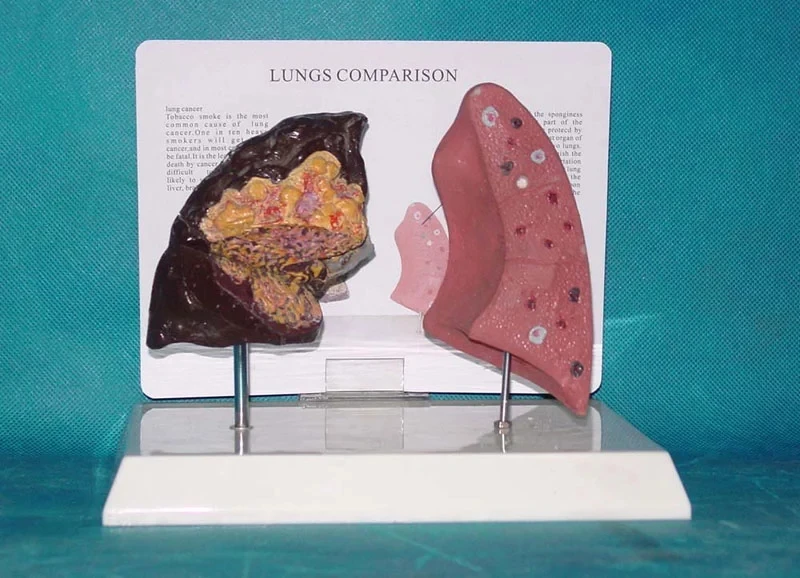 Smoking-Lung-and-Normal-Lung-Comparison-Model-Lung-Anatomy-Model ...