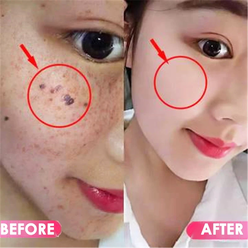 20ML Mole & Skin Tag Repair Solution Painless Mole Skin Dark Spot ...
