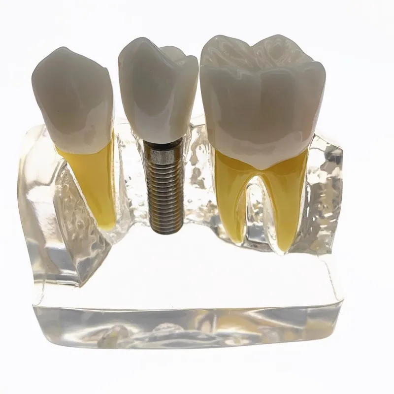 Clear Dental Demonstration Study Teeth Model For Implant Analysis Crown ...