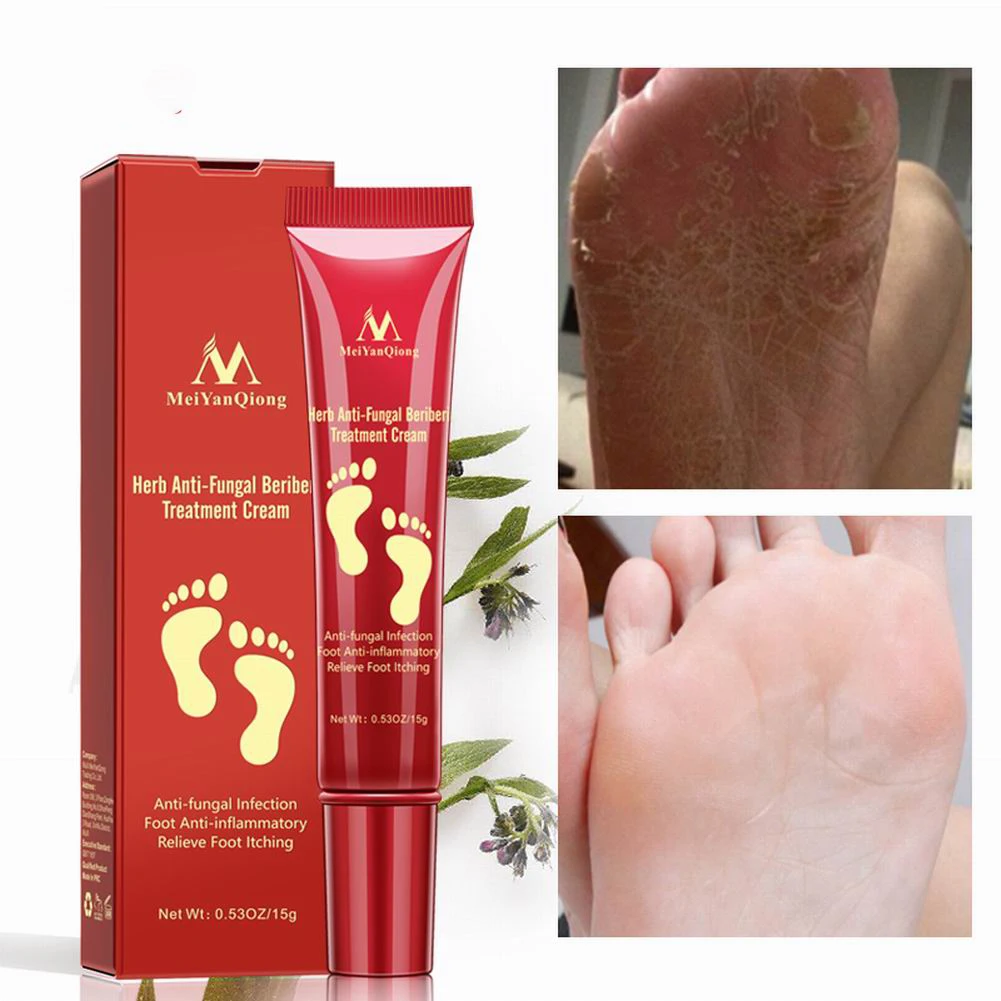 Herbal Anti Fungal Foot Cream Infection Anti inflammatory Fungus Feet ...