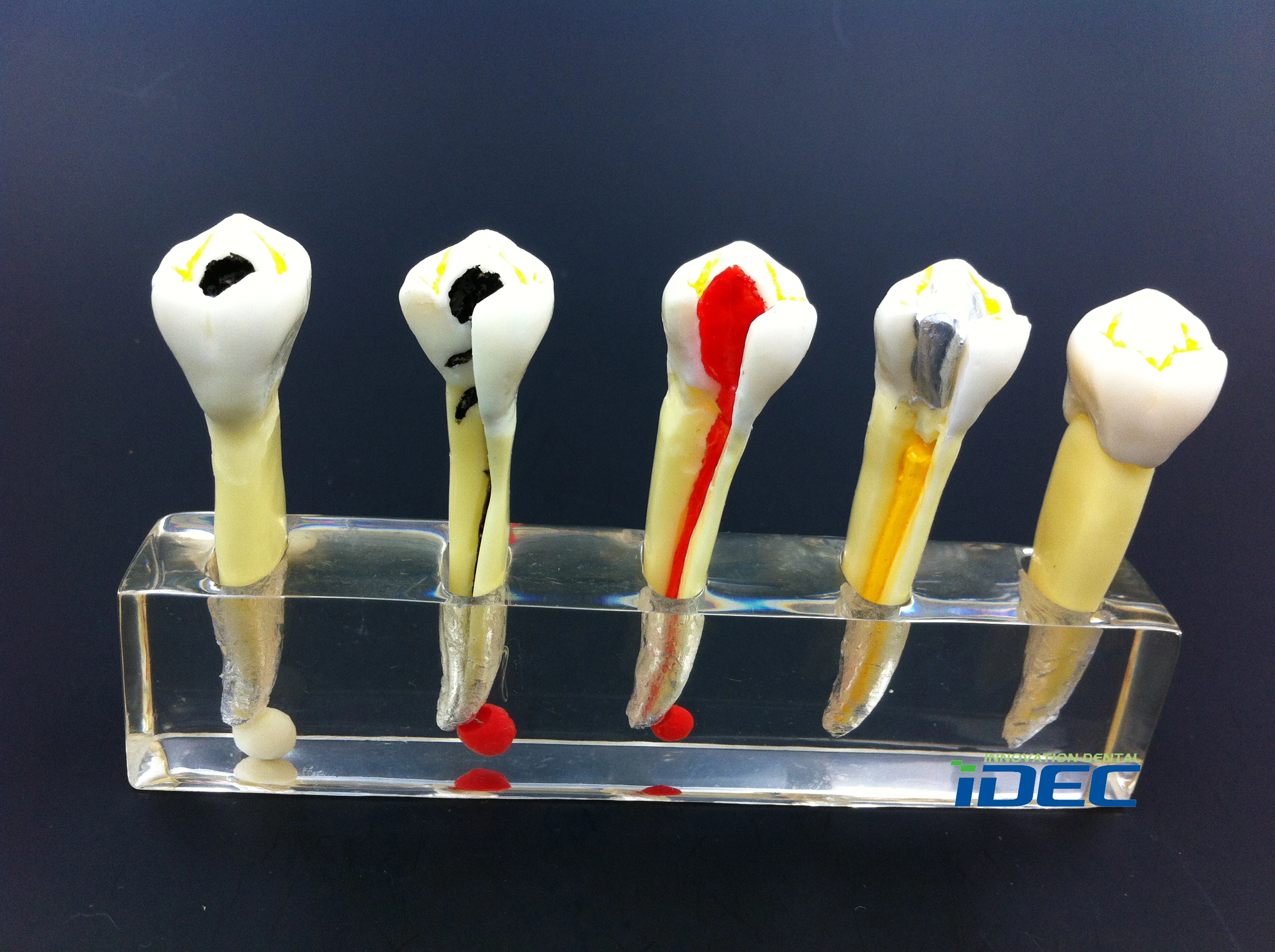 Dental-Model-Display-5-Stage-of-Endodontic-Treatmen-in-Root-Canal ...