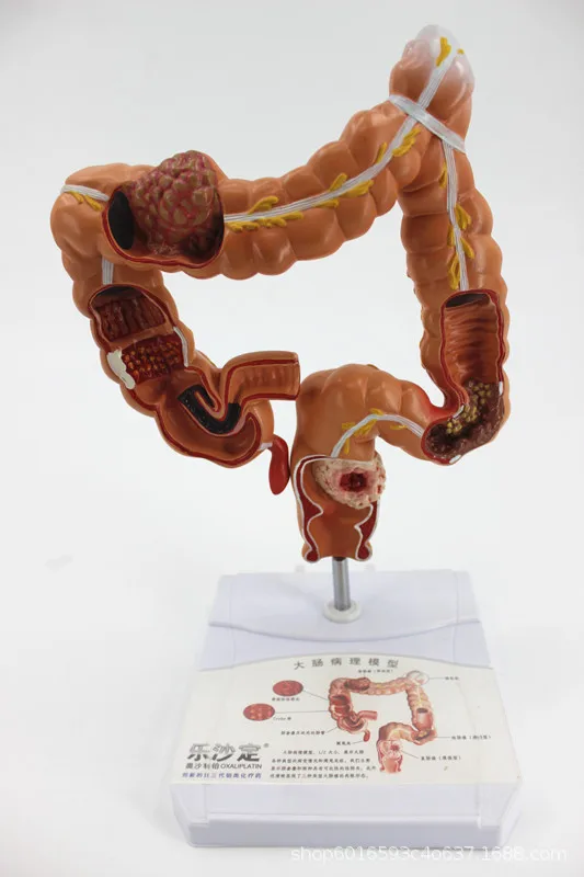 1-1-Life-Size-Anatomy-Human-Colon-Pathology-Model-Colorectal-Lesions ...
