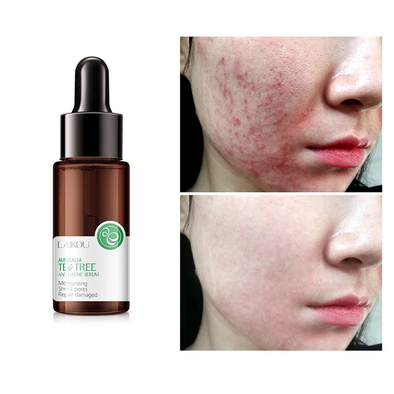 Teatree Anti Acene Face Serum Remove Pimples Fade Acne Marks Shrink Teatree Anti Acene Face Serum Remove Pimples Fade Acne Marks Shrink