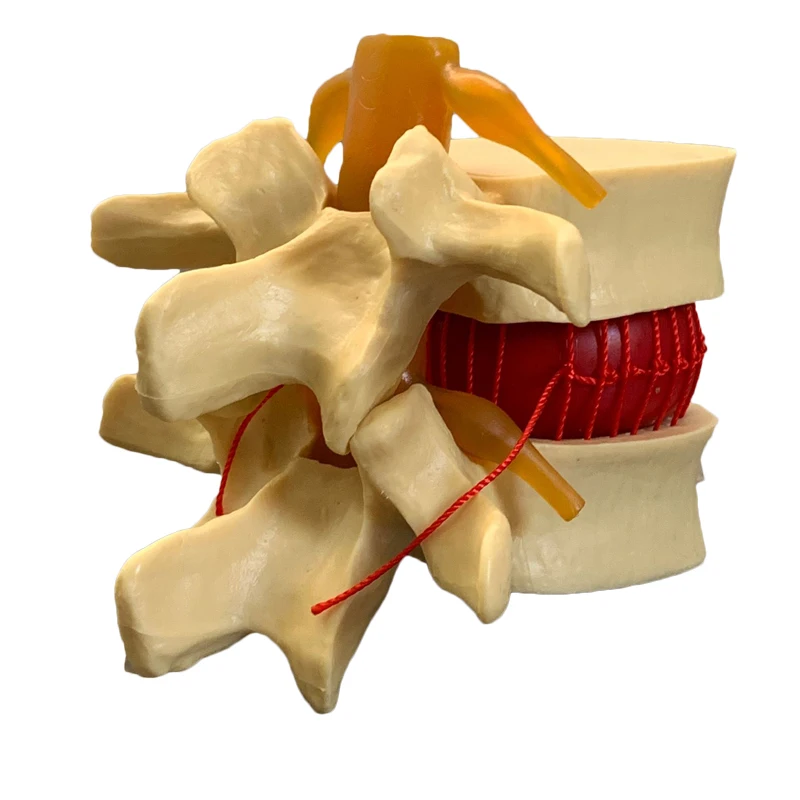 Lomber-intervertebral-disk-lomber-disk-hernisi-modeli-omurga-bel ...