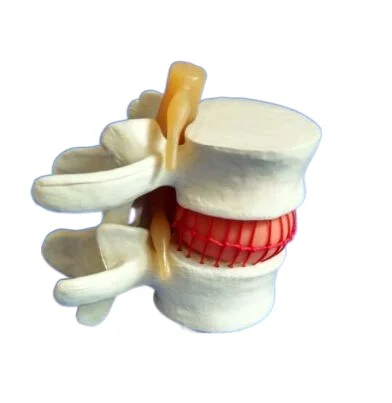 Intervertebral Disc Herniation Model Vertebral Disc Lesion Model ...