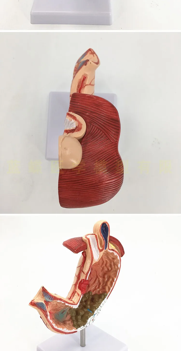 Diseased Stomach Model with Diaphragm Demonstration Model Pathological ...