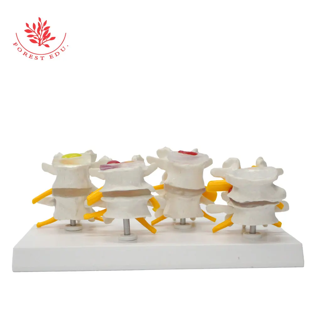 Human-Spine-Model-Lumbar-Vertebrae-Spine-Normal-Pathological-Models ...