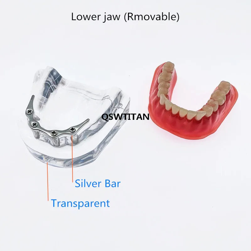 Teeth-model-with-implant-with-Silver-Bar-Denture-Repair-Teeth ...