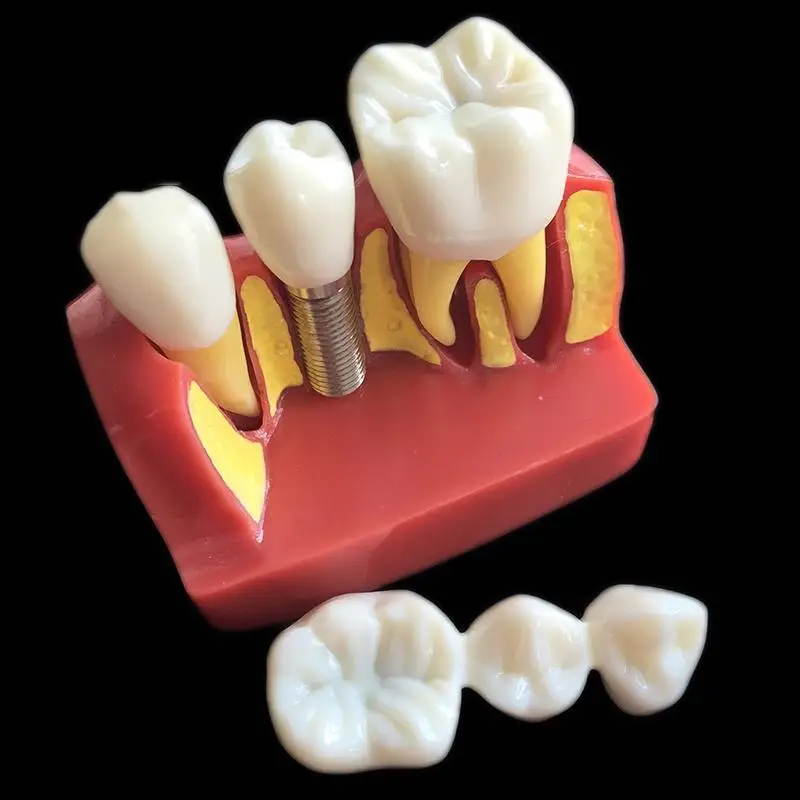 1-PC-4-times-Implant-Disease-Teeth-Model-Oral-Teaching-Model-Dental ...