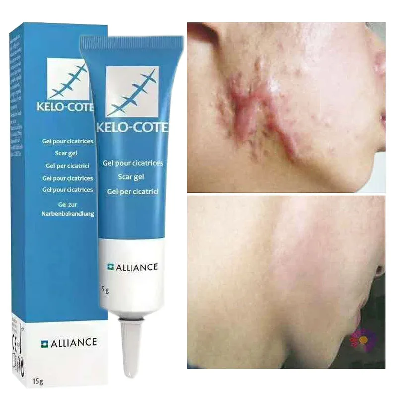 Litteken Verwijdering Creme Acne Littekens Gel Striae Chirurgische ...