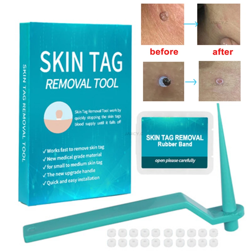 Micro Band Tag Removal Kit Papillomas Treatment Face Care Mole Wart ...