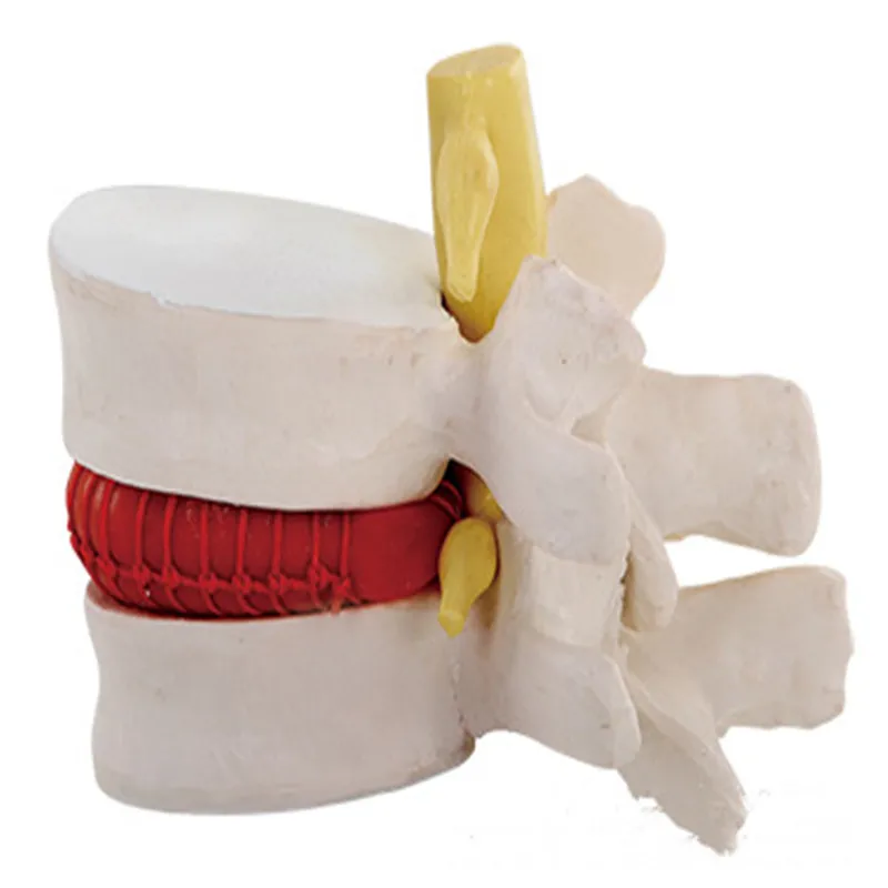 Pathological-Intervertebral-Disc-Herniation-Pathological-Intervertebral ...