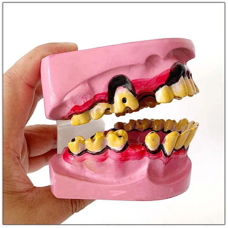 Modelo-de-dente-patol-gico-humano-C-lculo-dent-rio-T-rtaro-Medical ...