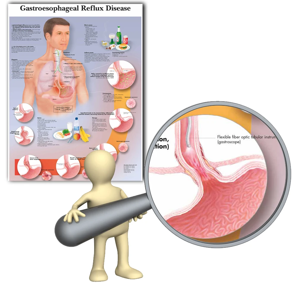 Gastroesophageal Reflux Disease Chart Poster Print Canvas Painting Wall ...