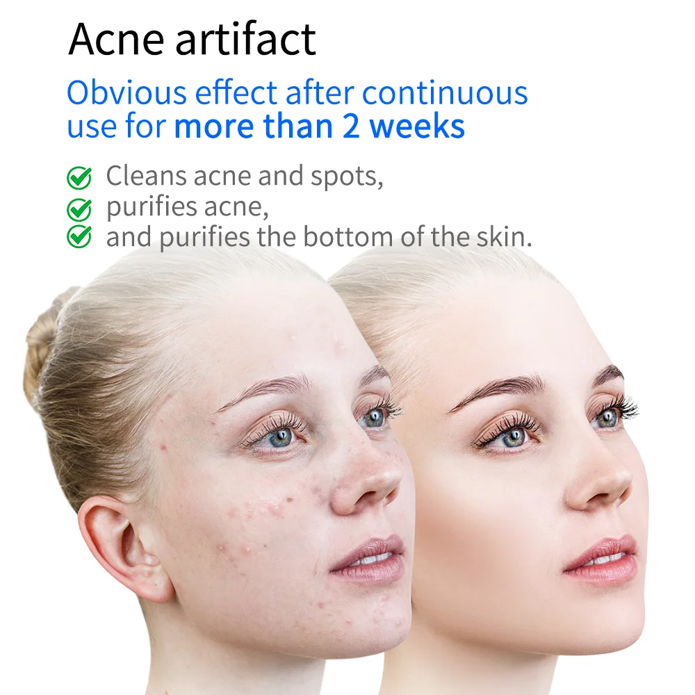Scar Zone Acne