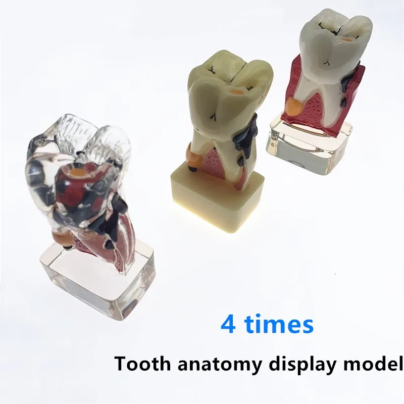 Dental-Teeth-Model-4-times-tooth-pathology-model-Comprehensive ...