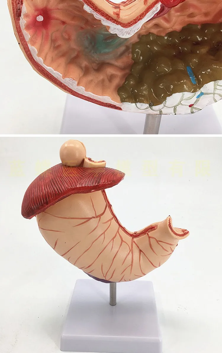 Diseased Stomach Model with Diaphragm Demonstration Model Pathological ...