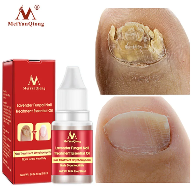 Igh Penetration, No Irritation, Regrowth Of Nail Or Toenail.nail Fungus ...