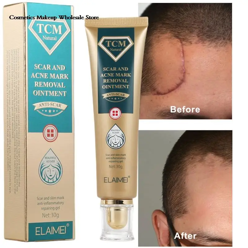Herbal-Burn-Surgical-Scar-Remove-Cream-Gel-Fade-Acne-Repair-Pock-Mark ...