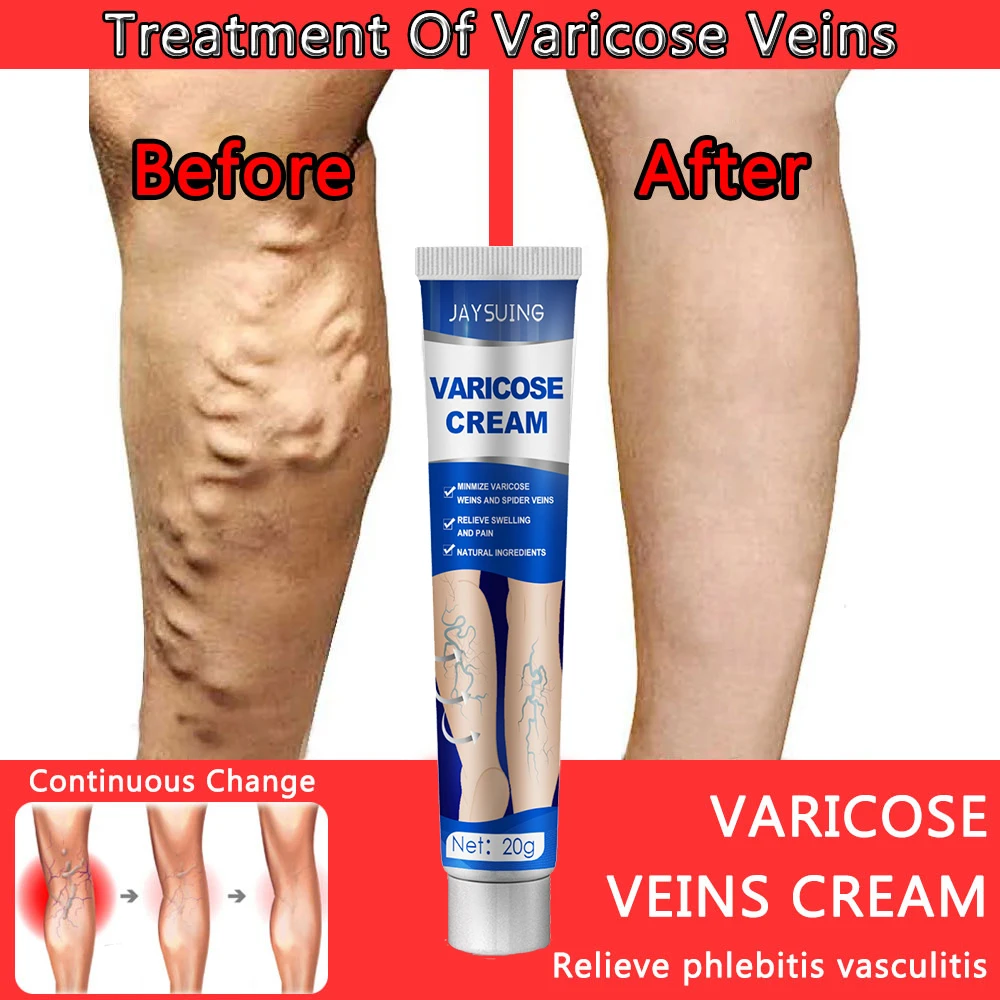 Effective Varicose Vein Relief Cream Ointment For Varicose Veins To ...