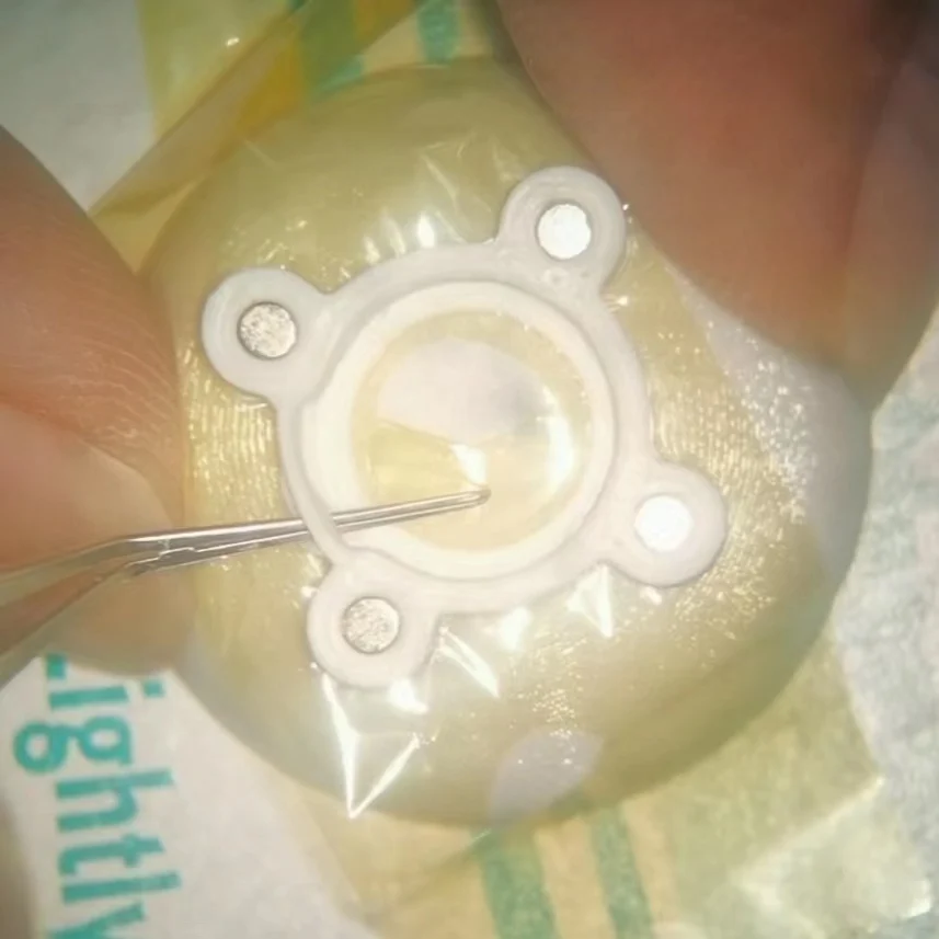 Ophthalmology-Phacoemulsification-Capsulorhexis-forceps-Circular ...