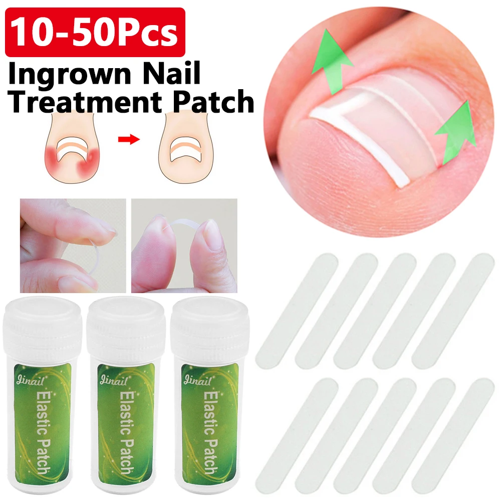 10-50Pcs-Toenail-Straightening-Clip-Ingrown-Toenail-Correction-Tool ...
