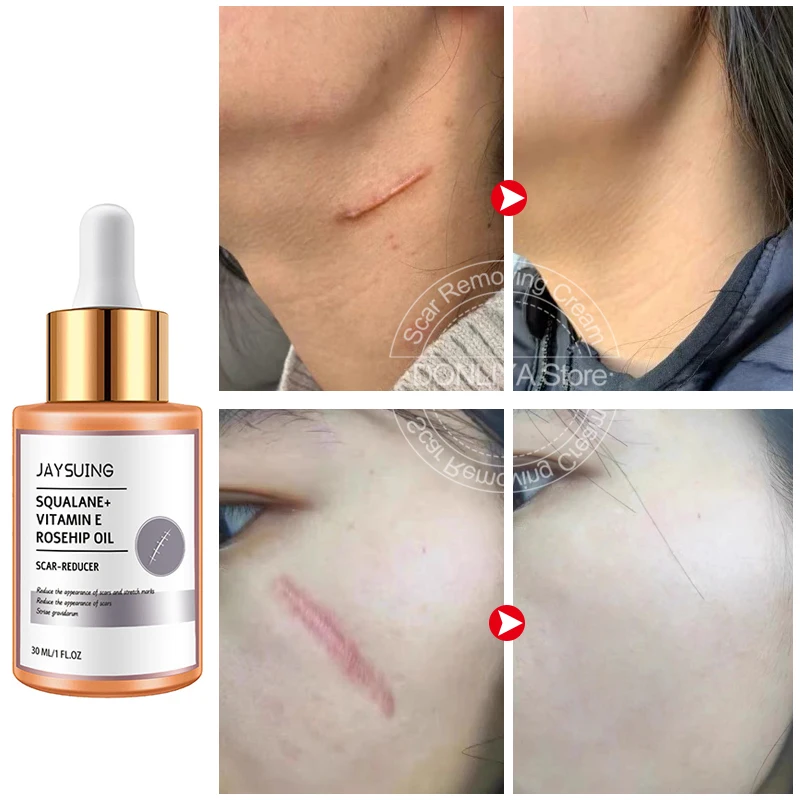 Scar-Removal-Cream-Surgical-Scar-Hyperplasia-Burn-Scar-Removal-Cream ...