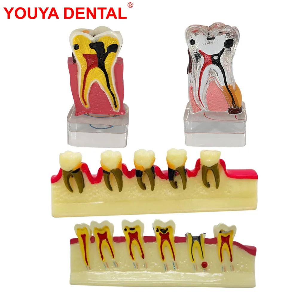 Dental Teeth Model Periodontal Disease Model Dentistry Tooth Model ...