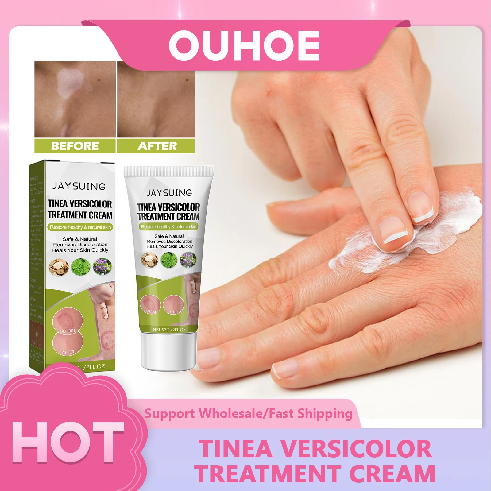 Tinea Versicolor Treatment