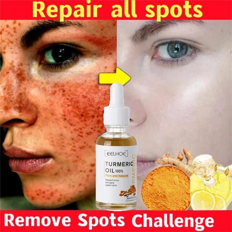Whitening Freckle Serum Oil Fast Brighten Remove Dark Spot Fade Pigment Melanin Correcting Anti ...