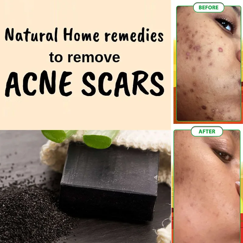How To Remove Pimples Marks