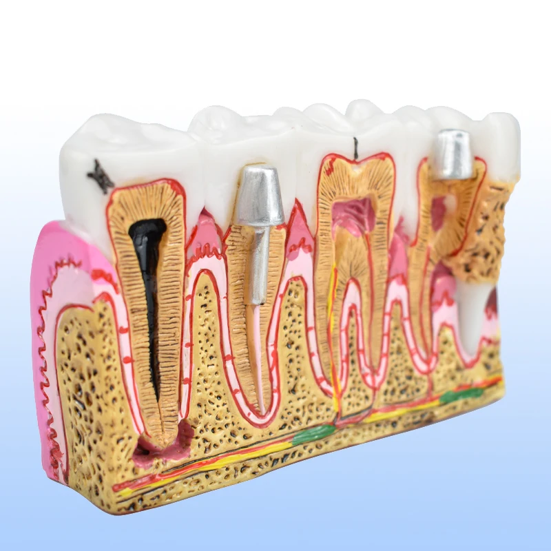 Modelo-de-anatom-a-de-Caries-dentales-patolog-a-integral-modelo-de ...