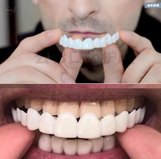 2Pair-Upper-and-Lower-Fake-Tooth-Kit-Veneers-Teeth-Temporary-False ...