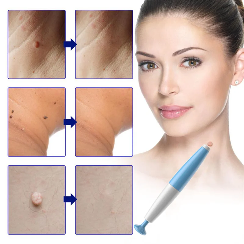 1Set-Skin-Tag-Removal-Skin-Cleansing-Kit-For-2-4mm-Skin-Tag-Treatment ...