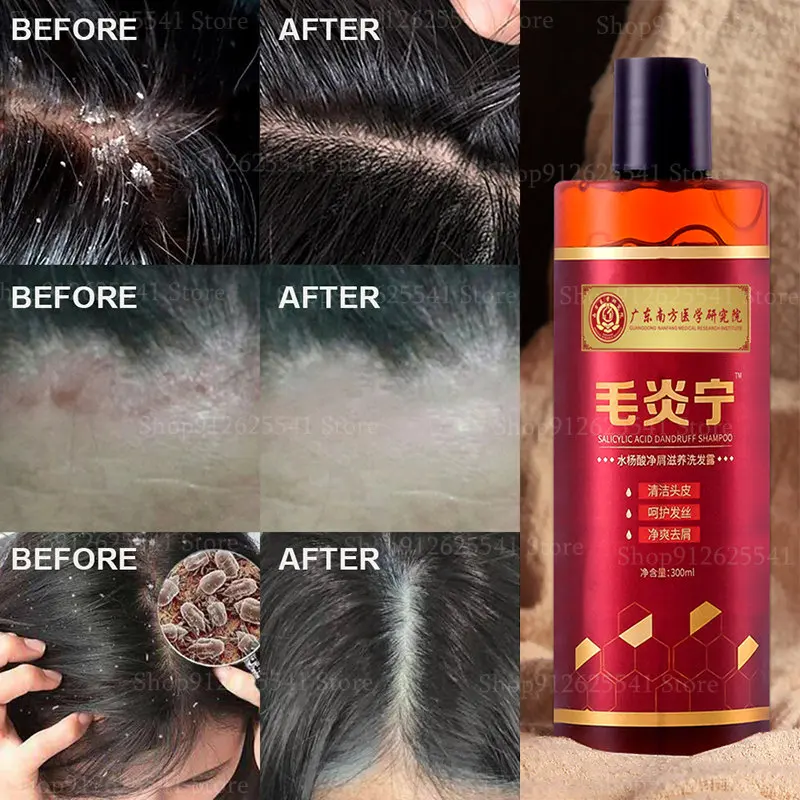 300ML-Chinese-Herbal-Anti-Dandruff-Anti-Itch-Shampoo-Remove-Dandruff ...