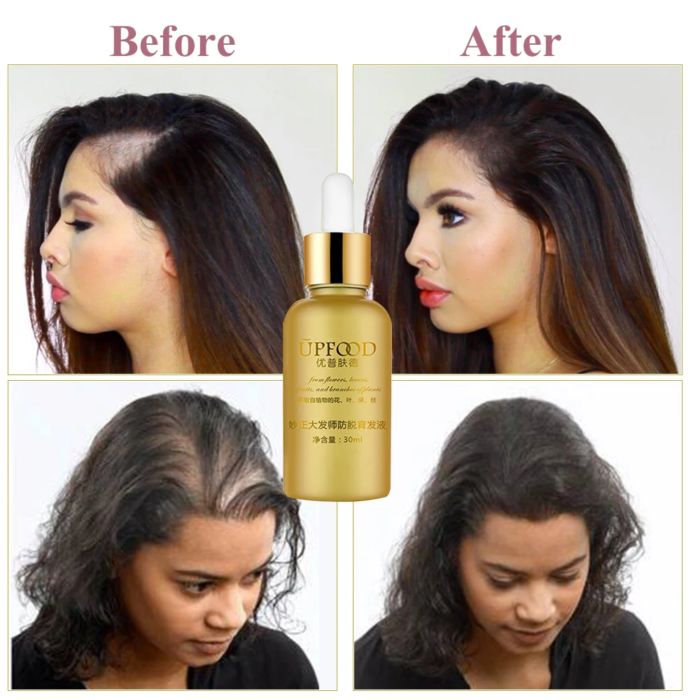 Hair-Growth-Serum-Spray-Anti-Hair-Loss-Essence-Nourishing-Soften-Scalp ...