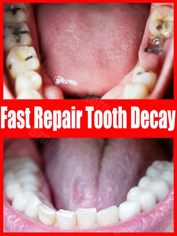 Tooth-Decay-Repair-Cavities-Protect-Teeth.jpg