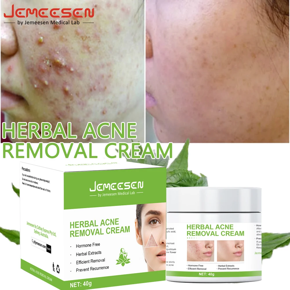 Jemeesen Acne Removal Face Cream Control Anti-acne Creamtreatment Acne Mark Skin Care Whitening ...