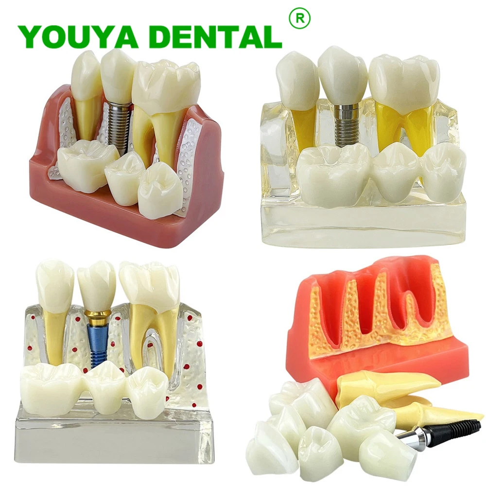 4-Times-Dental-Implant-Demonstration-Model-Teeth-Implant-Analysis-Crown ...