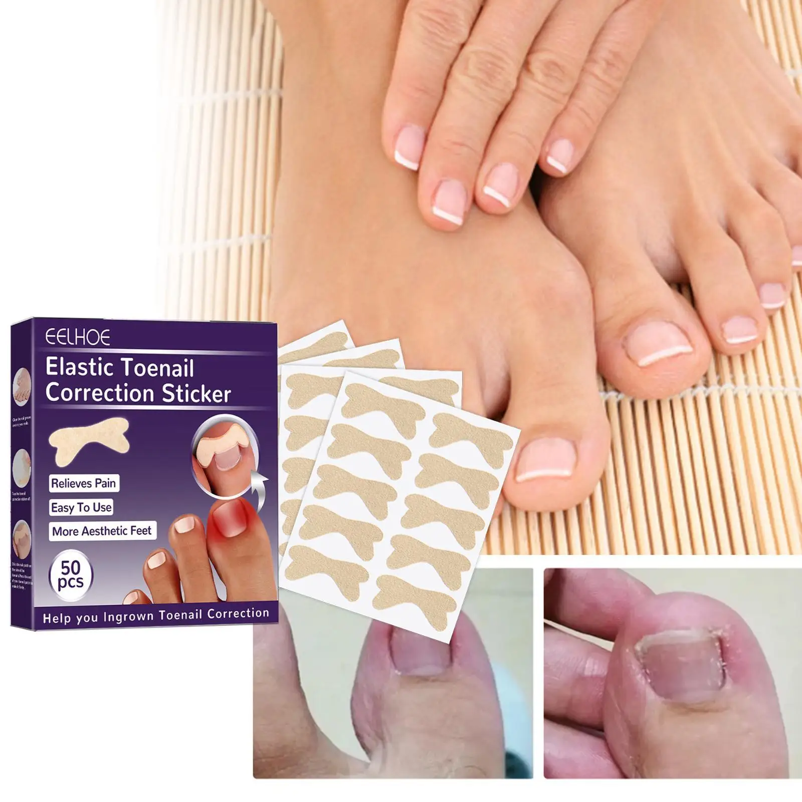 50pcs Nail Ingrown Correction Sticker Treatment Paronychia Relief Pain ...