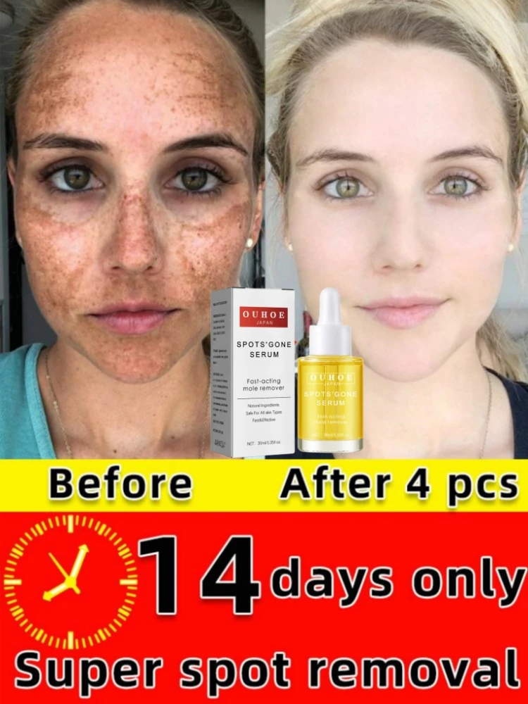 Whiten-Freckles-Removal-Serum-Fast-Remove-Chloasma-Dark-Spots-Age-Spots ...