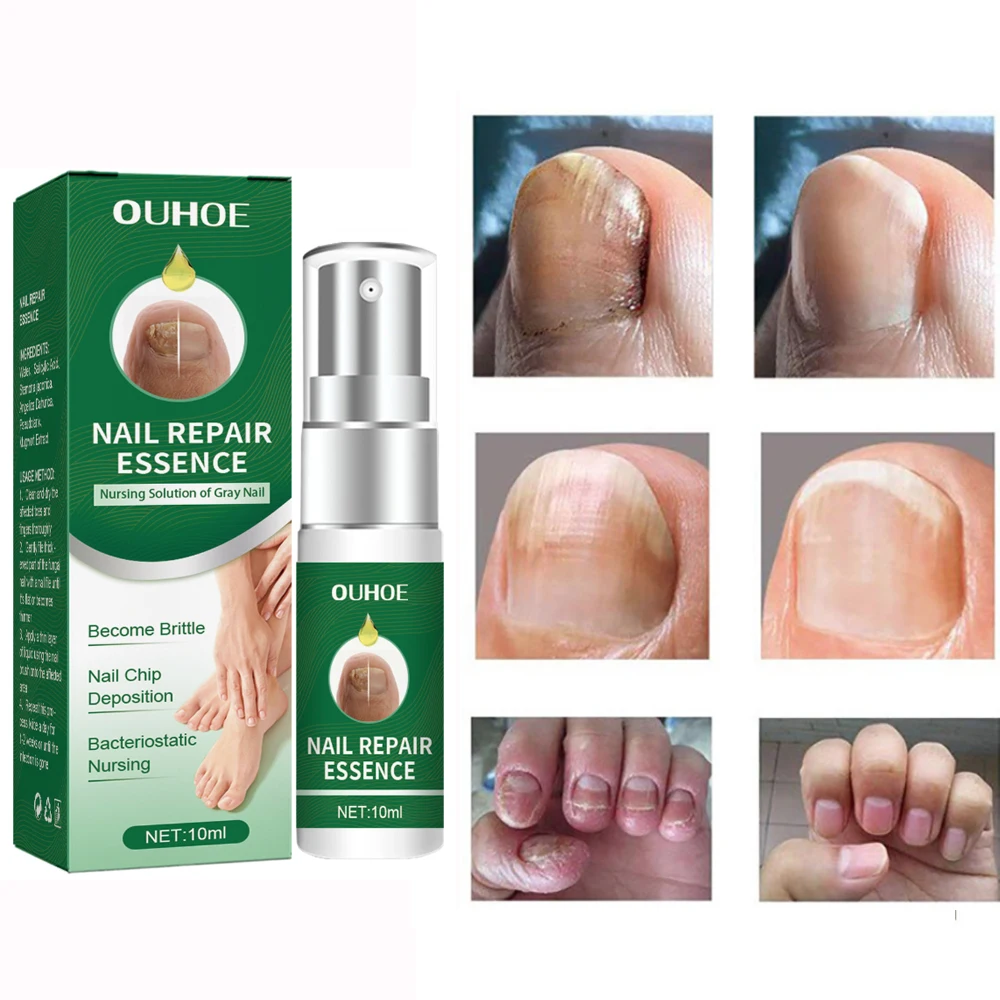 Fungal Nails Repair Remedio Para Fungo Nas Unhas Nagel Schimmel ...