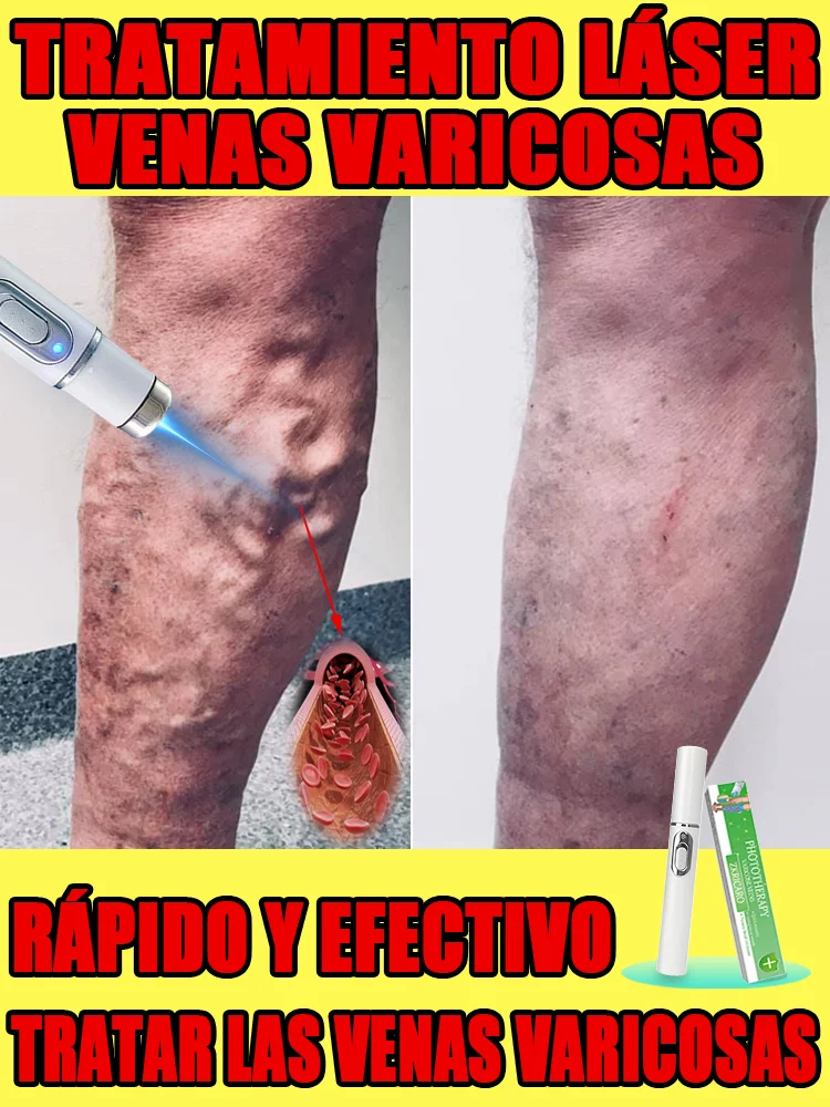 Potente-terapia-l-ser-para-venas-varicosas-moderadas-alivia-el-dolor-y ...