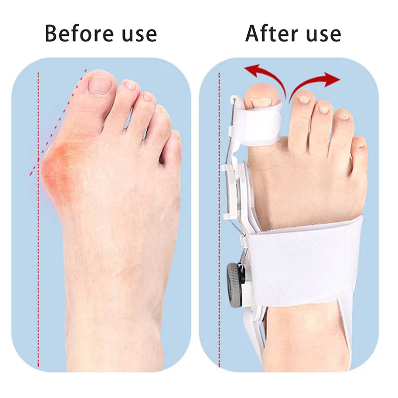 Hallux Valgus Corrector Orthotic Bone Bundle Corrector Thumb ...