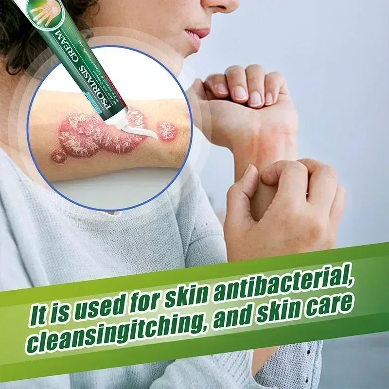 Herbal-Psoriasis-Treatment-Cream-Antibacterial-Anti-itch-Ointment ...