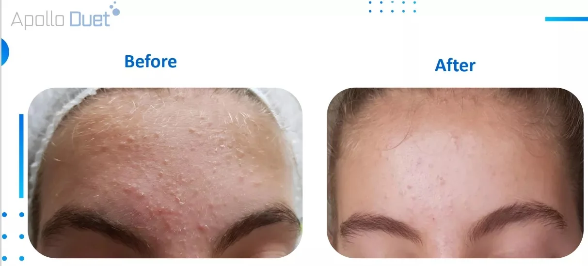 Apollo Duet Multipolar RF Technology With Electroporation For Skin ...